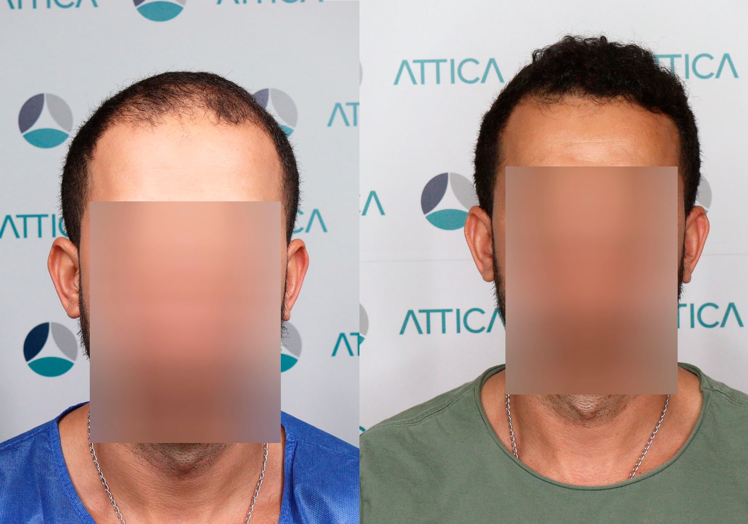 Como fazer Transplante Capilar: Saiba neste testemunho! - Attica