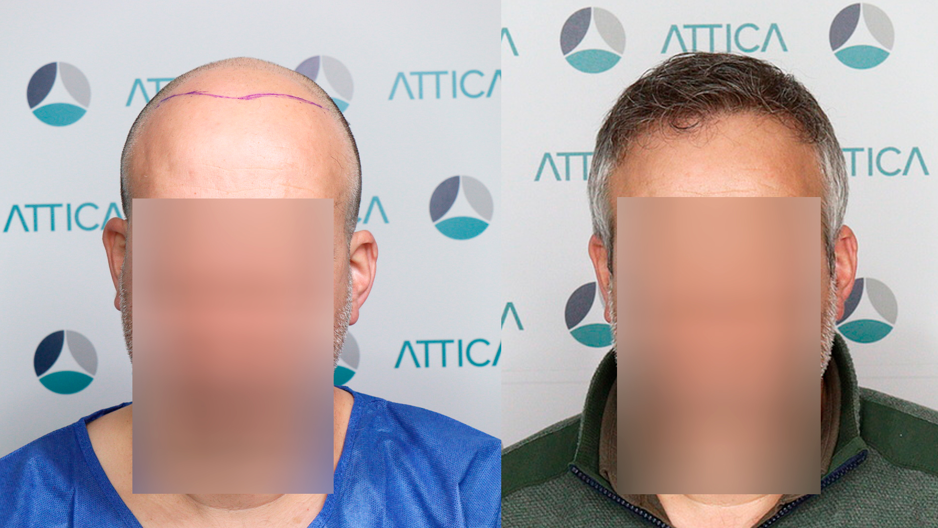 Pós Transplante Capilar da Attica! - Attica